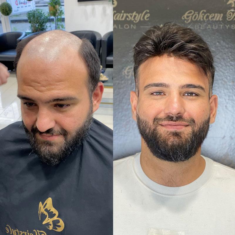 Hair Systems Before and After | Toupee Hairstyles