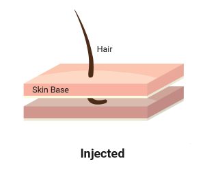 Skin Hair System Ventilations: V-loop, Injected Hair, & Knot