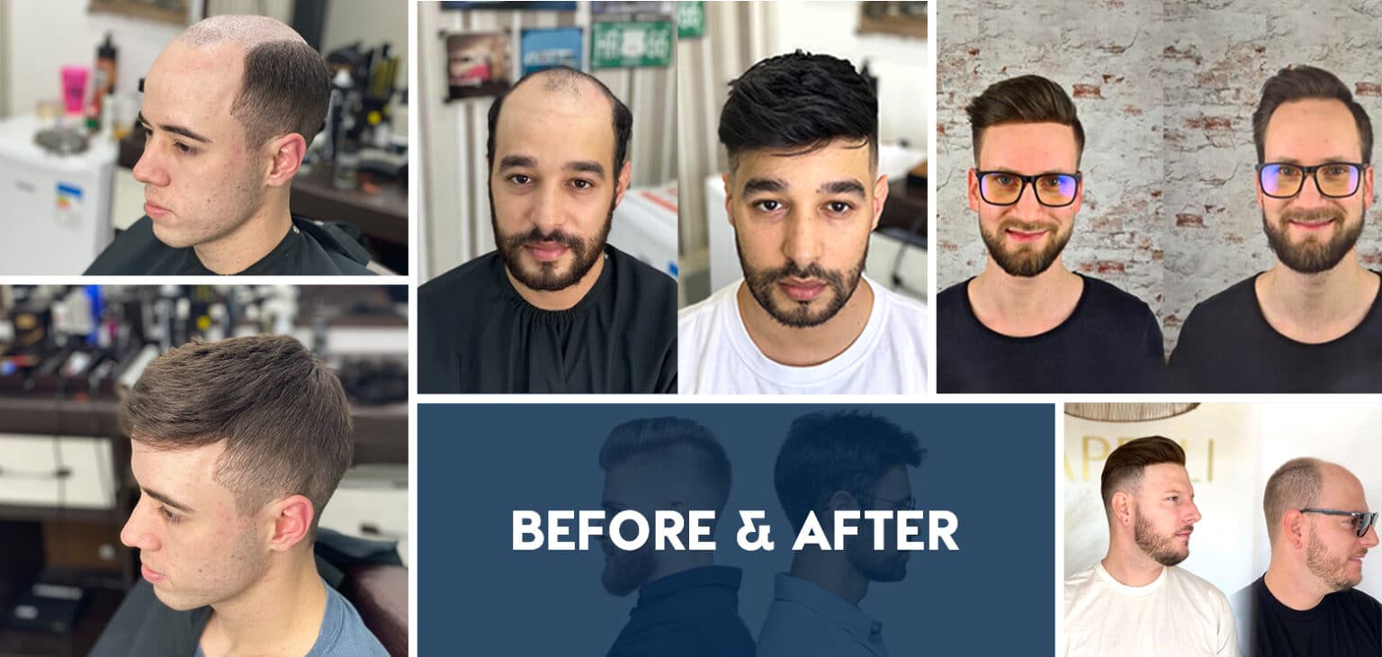 Natural Partial Hair System for Receding Hairline Wholesale