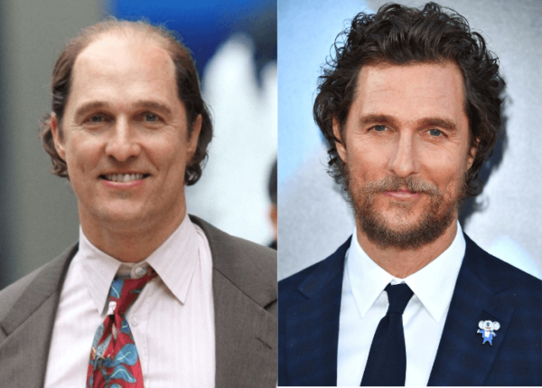 Male Celebrities Who Wear Toupees and Wigs Due to Hair Loss