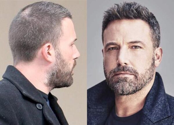 Male Celebrities Who Wear Toupees and Wigs Due to Hair Loss