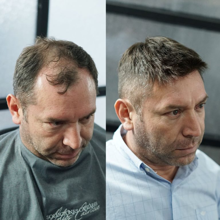 Hair Systems Before and After | Toupee Hairstyle