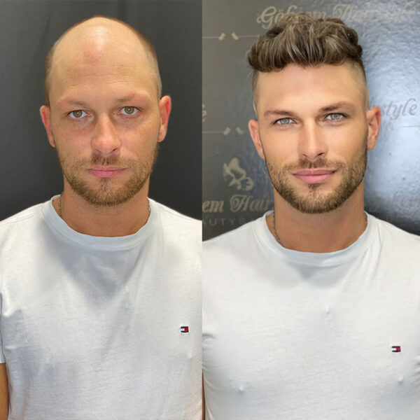 Hair Systems Before and After | Toupee Hairstyle