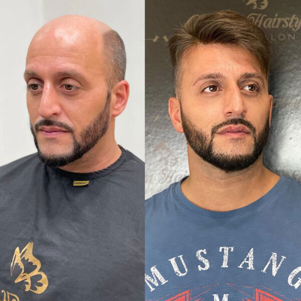 Hair Systems Before and After | Toupee Hairstyle