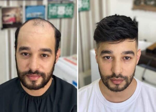 50 Balding Celebrities from the Famous Bald People Club