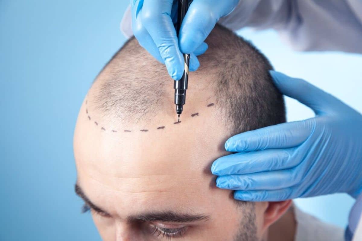 How to Fix Receding Hairline
