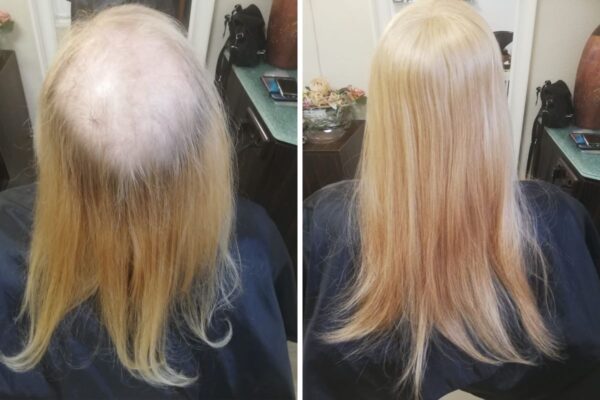Best Hair Extensions for Balding Crowns and How to Attach