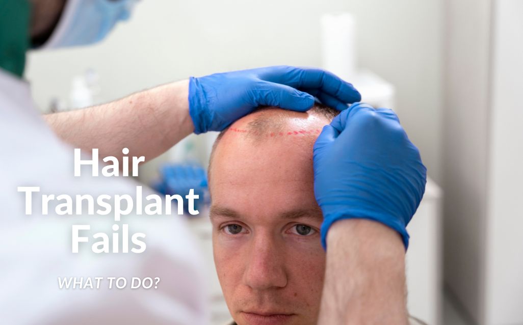 Failed Hair Transplant: How to Avoid or Fix It?