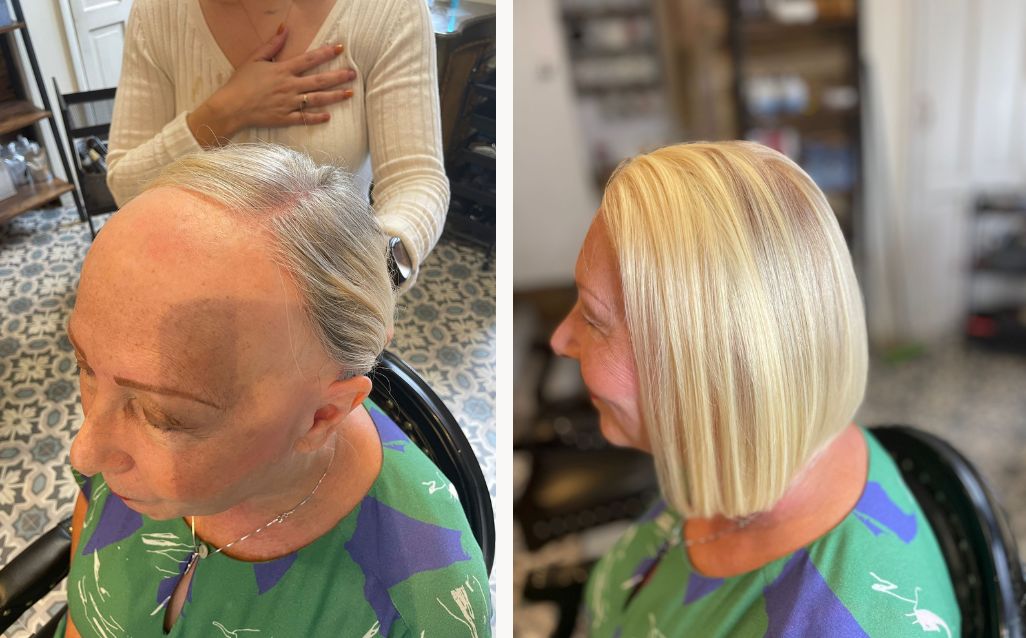 Hair Loss Hairstyles for Thinning Hair on Crown With Hair Systems