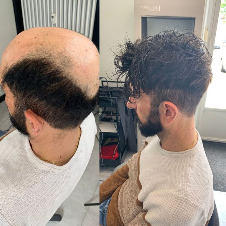 Hair Systems Before and After | Toupee Hairstyle