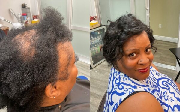 Hair Loss Hairstyles for Thinning Hair on Crown With Hair Systems