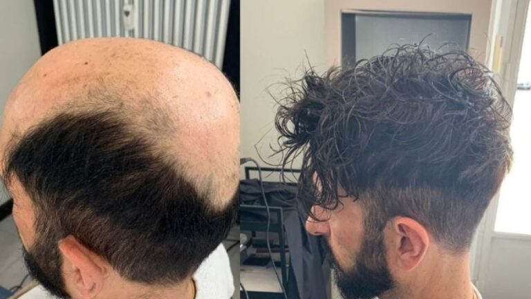 What Is a Toupee? A Guide & Newtimes Hair's 10 Best Toupees