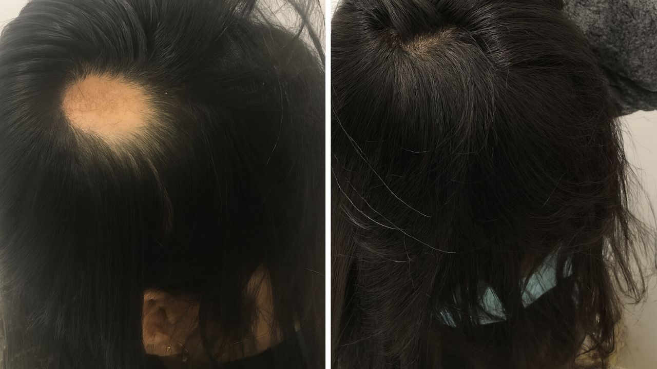Best Hair Pieces for Alopecia | A Review of Hair Patches