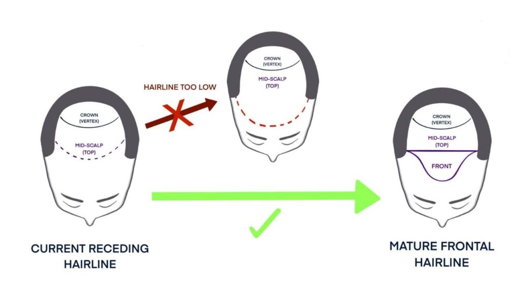 Is It Possible to Regrow Hair on a Receding Hairline?